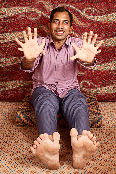 Record Holder Profile Video: Devendra Suthar - the man with the most fingers and toes | Guinness ...