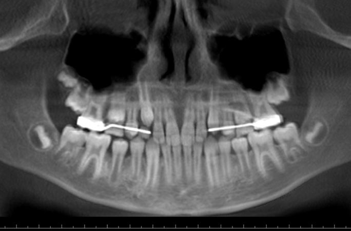 9-year-old becomes youngest ever to have a wisdom tooth extracted ...