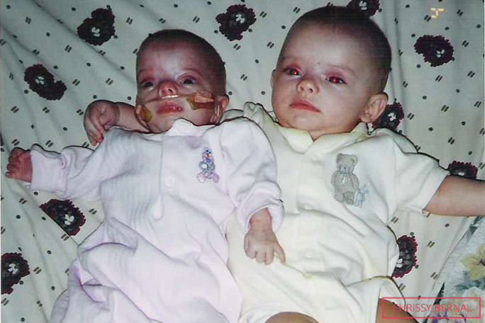 "They’re so different even though they’re 'identical' twins" | Guinness ...