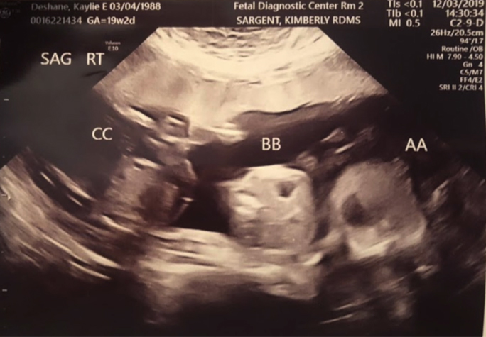 "They are warriors": Meet the premature triplets born in different ...