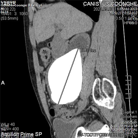 World’s largest and heaviest kidney stone removed from Sri Lankan man ...