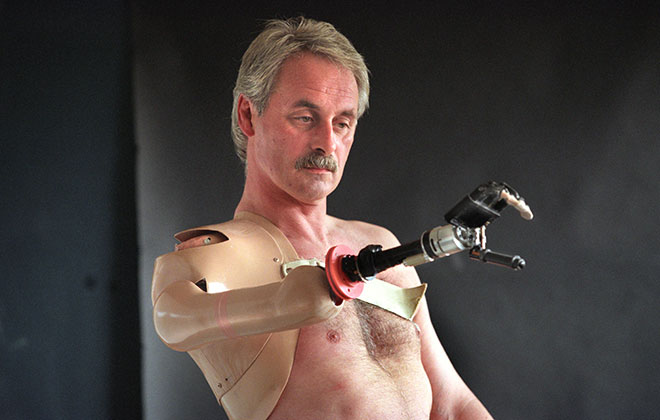 First bionic arm fitted on an individual (male) | Guinness World Records